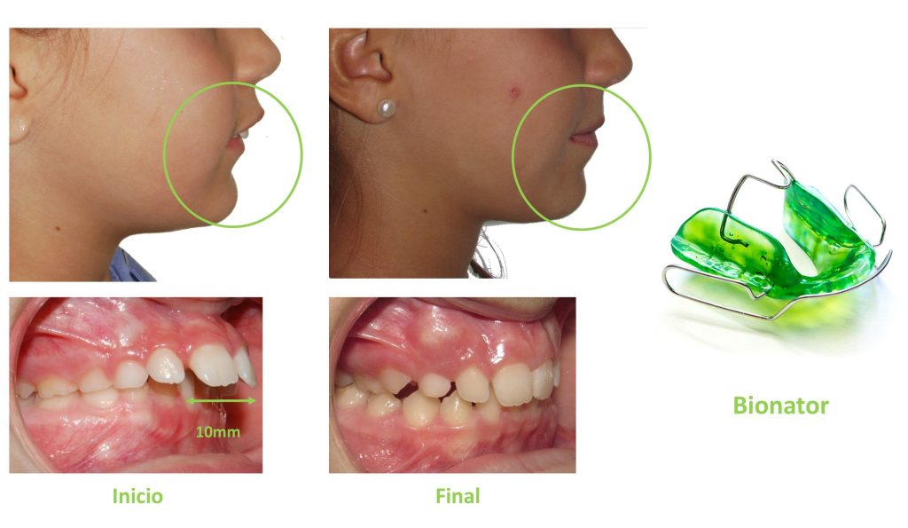 Vol. 7 Núm. 3. Julio 2023. Tratamiento de la clase II división primera ...